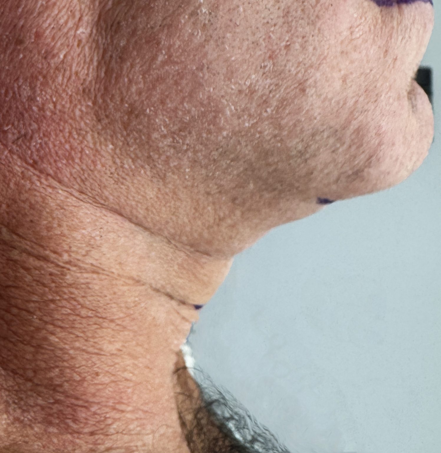 Adam's Apple Augmentation for Neck Masculinization Case Study - Explore ...