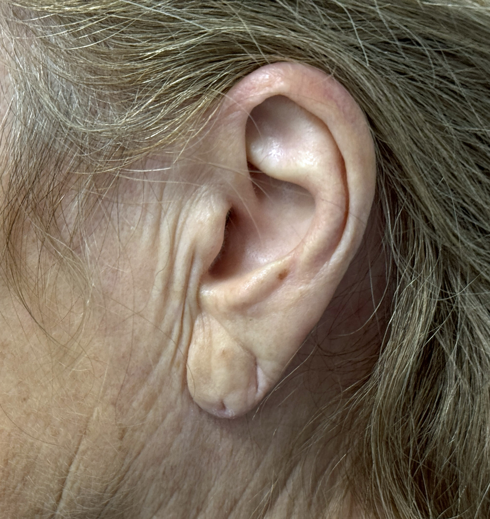 Earlobe Reduction Case Study Explore Plastic Surgery