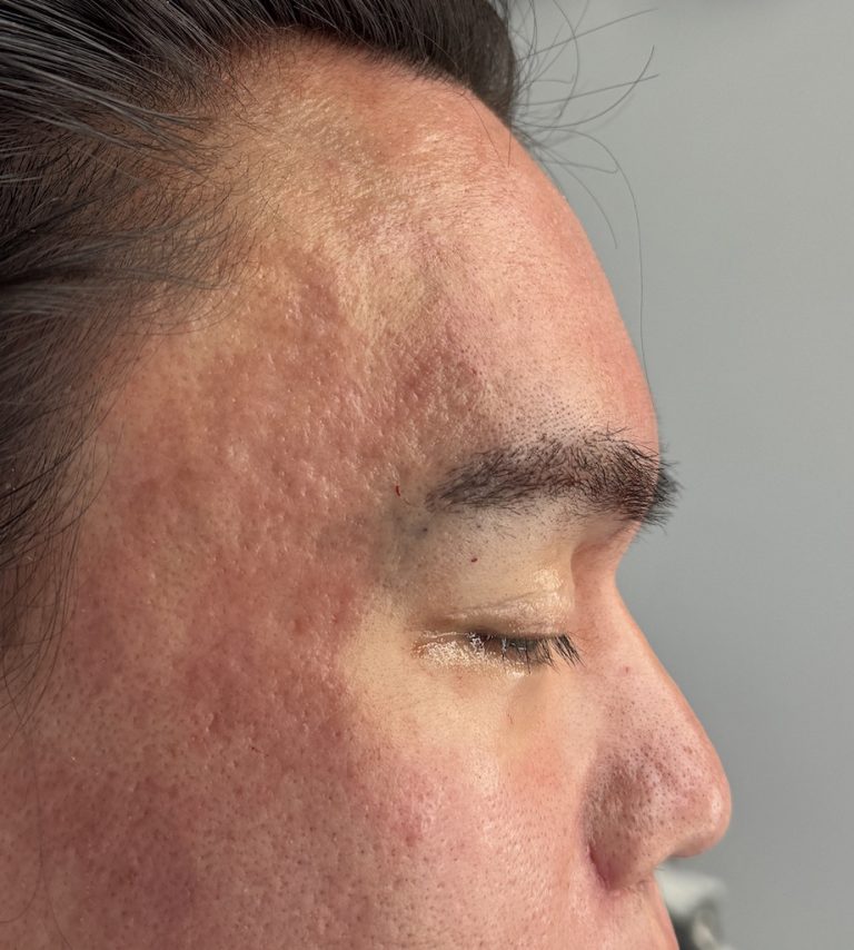 Male Custom Forehead Implant Case Study - Explore Plastic Surgery