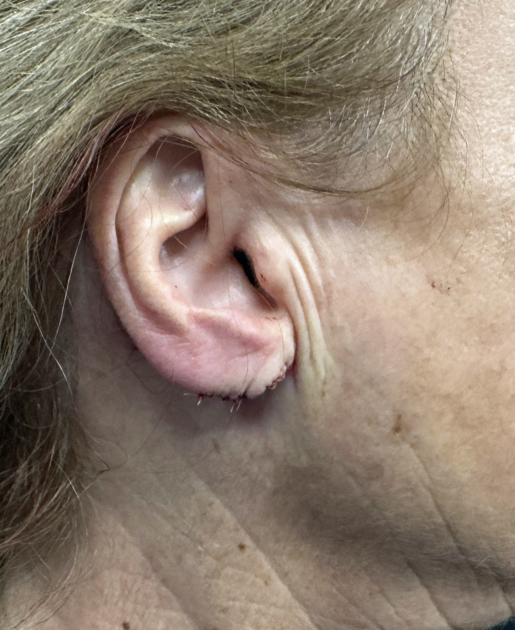 Earlobe Reduction Case Study Explore Plastic Surgery