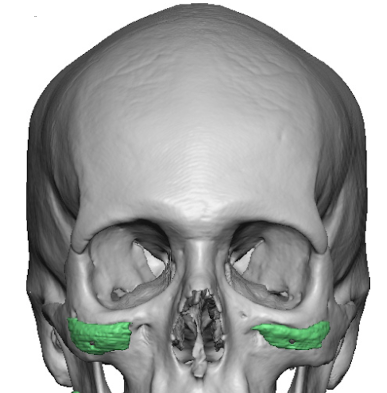 The Custom Orbital Frame Implant Case Study - Explore Plastic Surgery