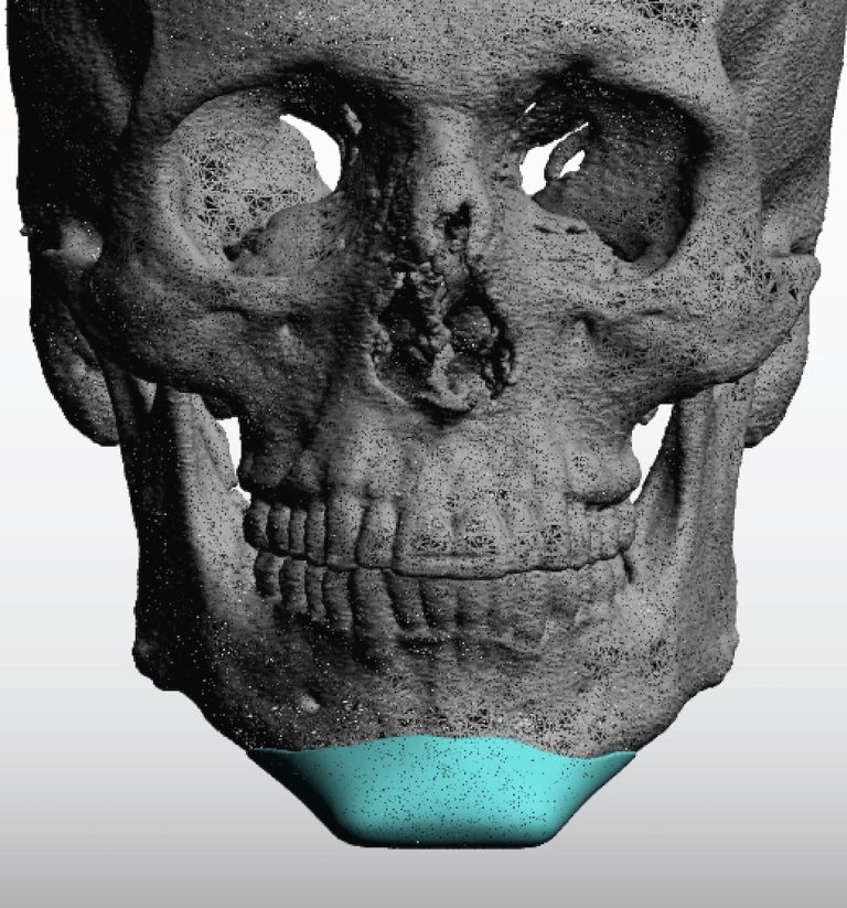 Design Guidelines for Custom Square Chin Implants for Men - Explore ...