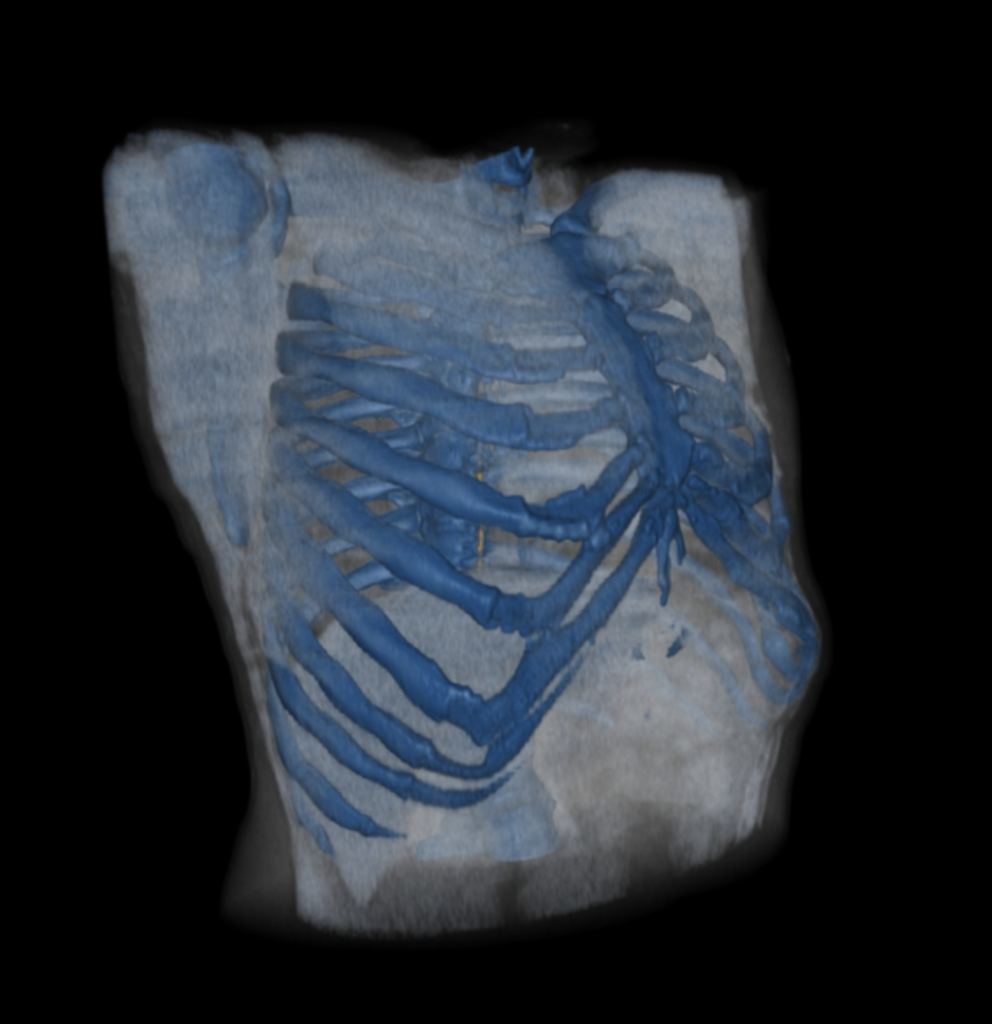 Rib 9 Osteotomy Technique for Ribcage Narrowing - Explore Plastic Surgery