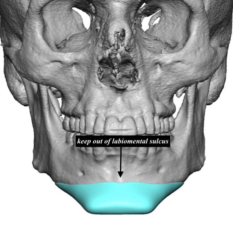 Design Guidelines for Custom Square Chin Implants for Men - Explore ...
