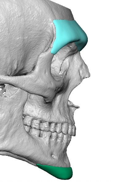 Custom Brow Bone Feminization Reversal -Case Study - Explore Plastic ...