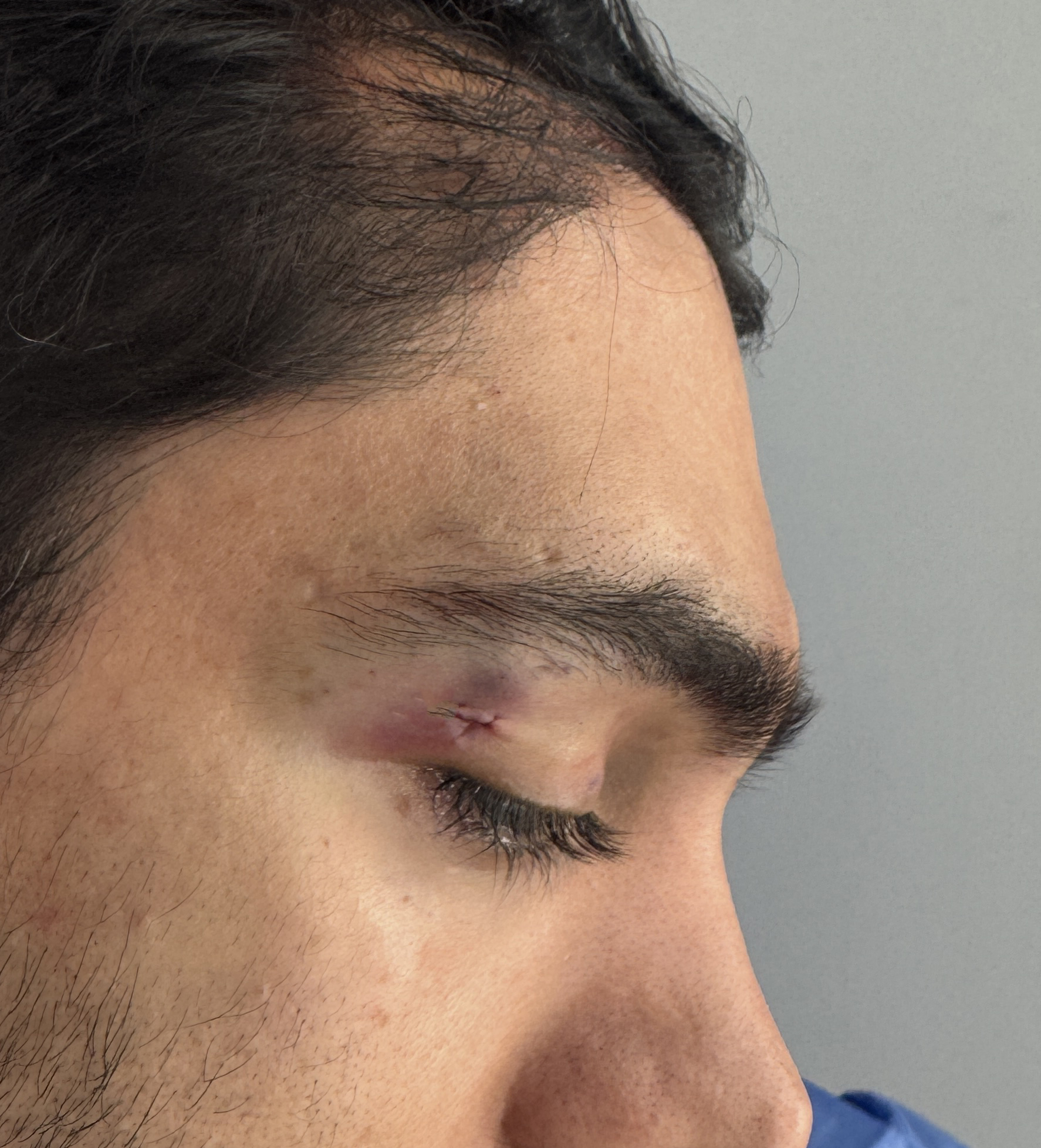 Custom Brow Bone Feminization Reversal -Case Study - Explore Plastic ...