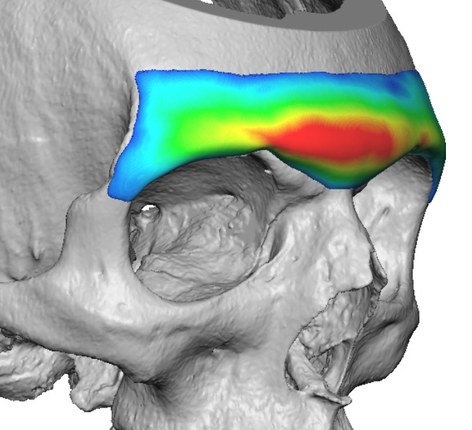 Custom Brow Bone Feminization Reversal -Case Study - Explore Plastic ...