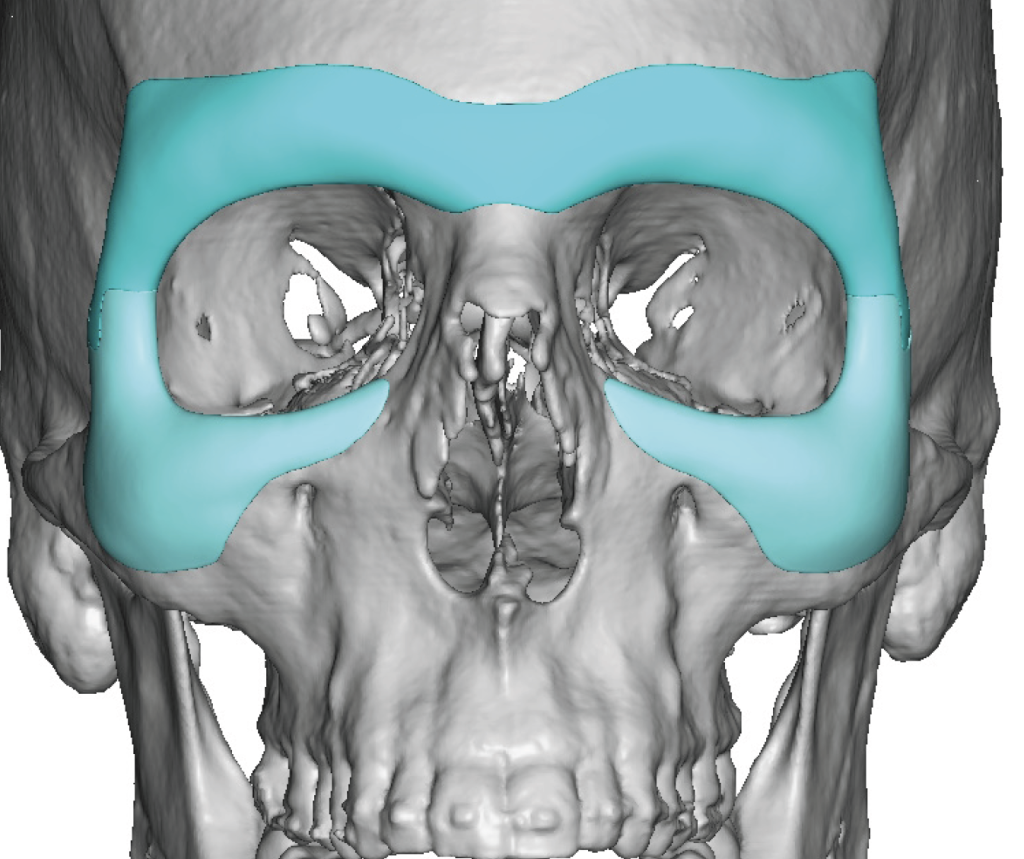 Custom Brow Bone Implant Design Options - Explore Plastic Surgery