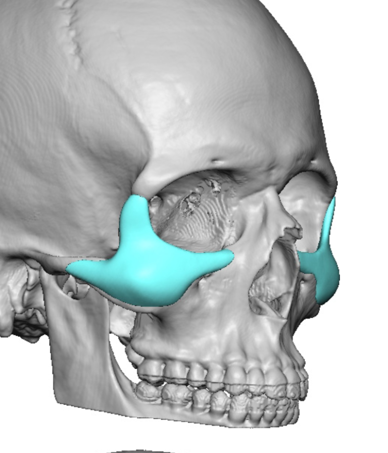 Negative Orbital Vector & Custom Infraorbital Implants: Case Study ...