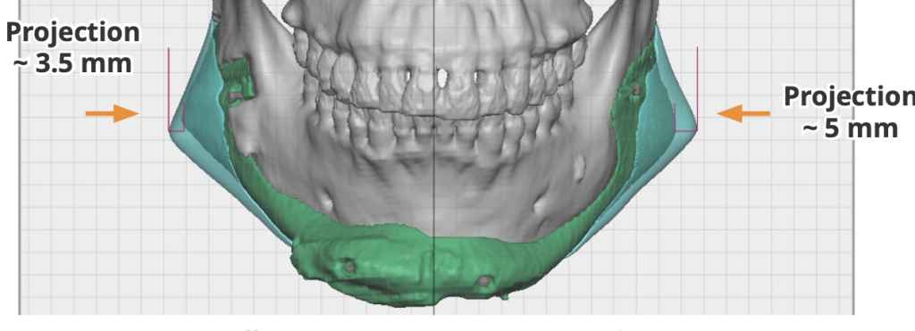 Custom Jaw Angle Implant Overlays: What They Are & How They’re Used ...