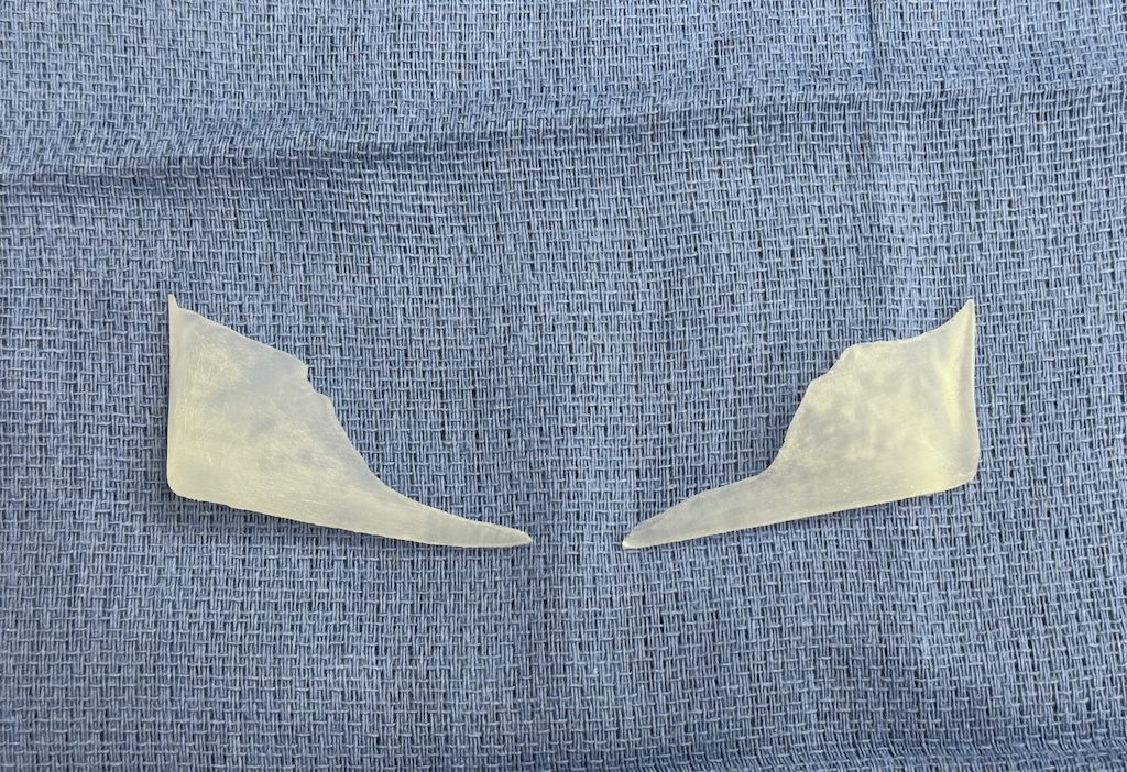 Custom Jaw Angle Implant Overlays: What They Are & How They’re Used ...