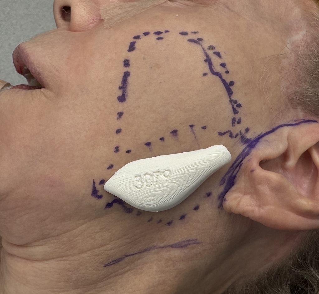Custom Jaw Angle Implant Overlay After TMJ Replacements for Facial ...