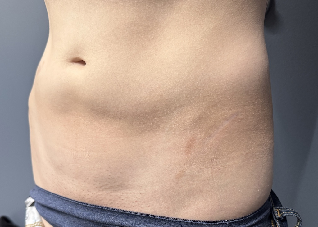 Pelvic Plasty for Female Body Contouring: Case Study and Long Term ...