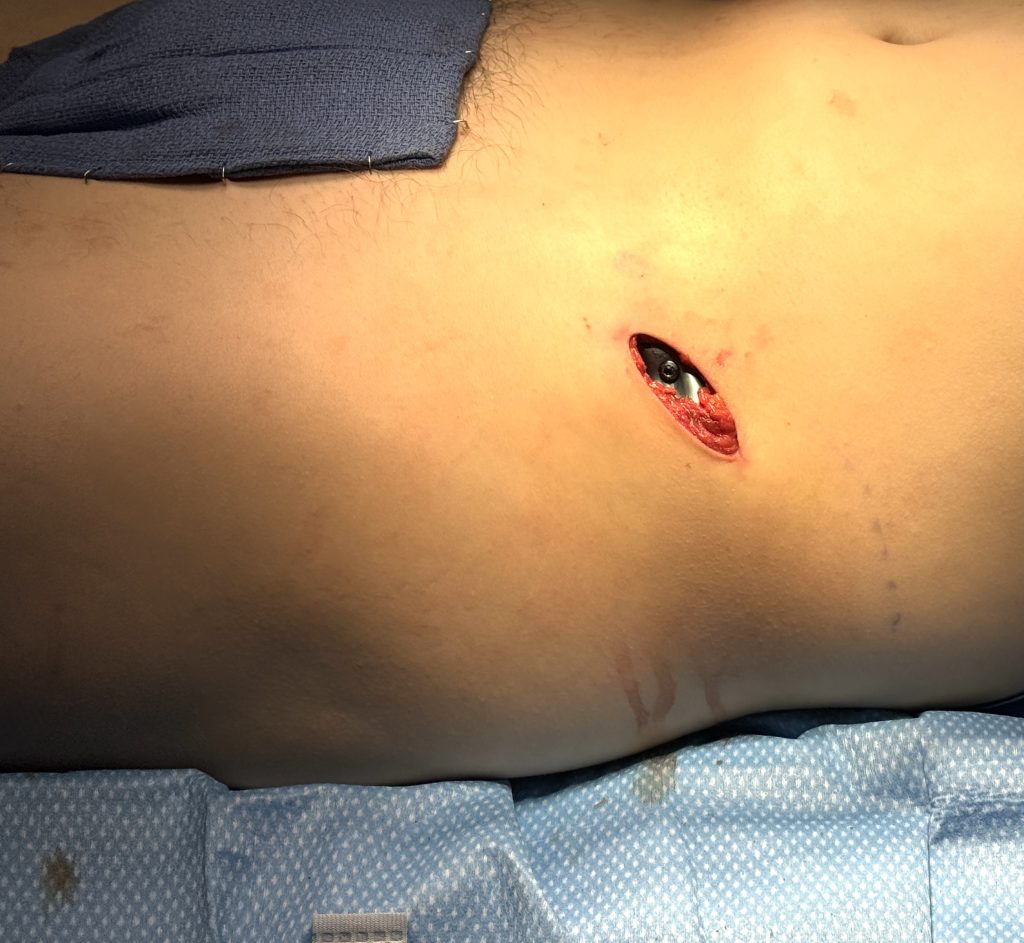 Pelvic Plasty for Female Body Contouring: Case Study and Long Term ...