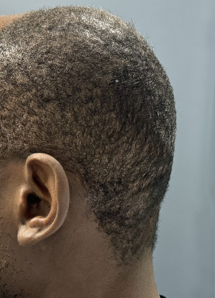 Occipital Bun Reduction with Scalp Roll Excision Case Study - Explore ...