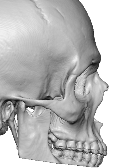 Negative Orbital Vector & Custom Infraorbital Implants: Case Study ...