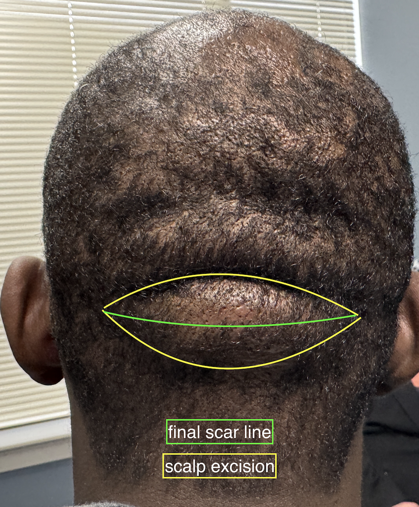 Occipital Bun Reduction with Scalp Roll Excision Case Study - Explore ...