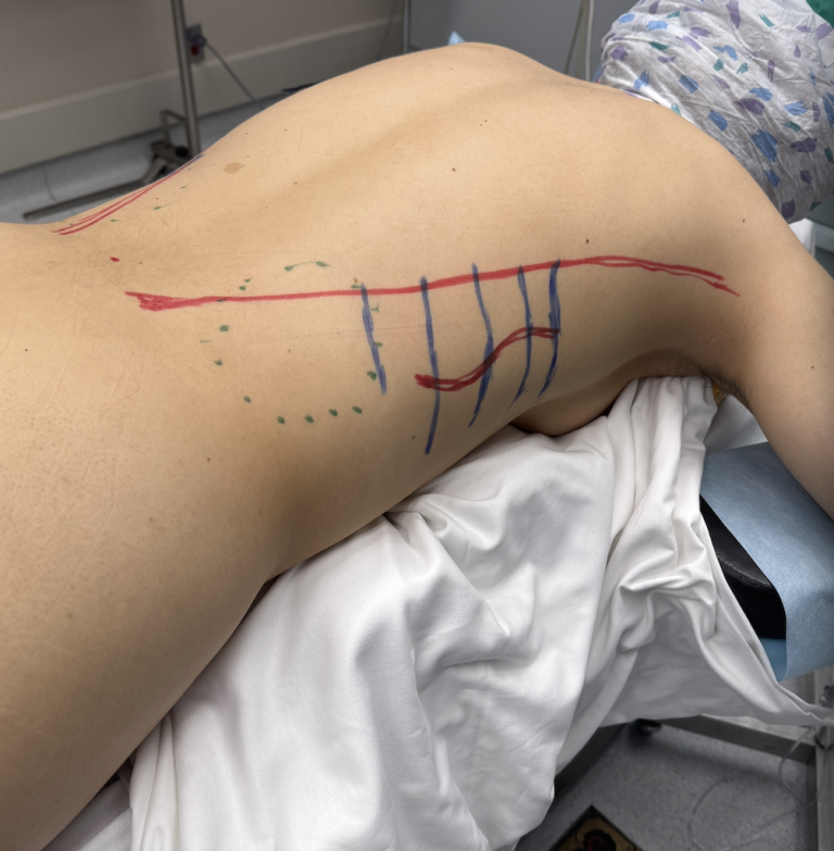 Torso Narrowing Surgery Concepts and Case Study - Explore Plastic Surgery