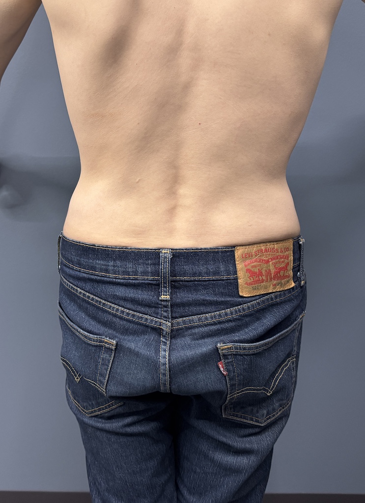 Pelvic Plasty for Female Body Contouring: Case Study and Long Term ...