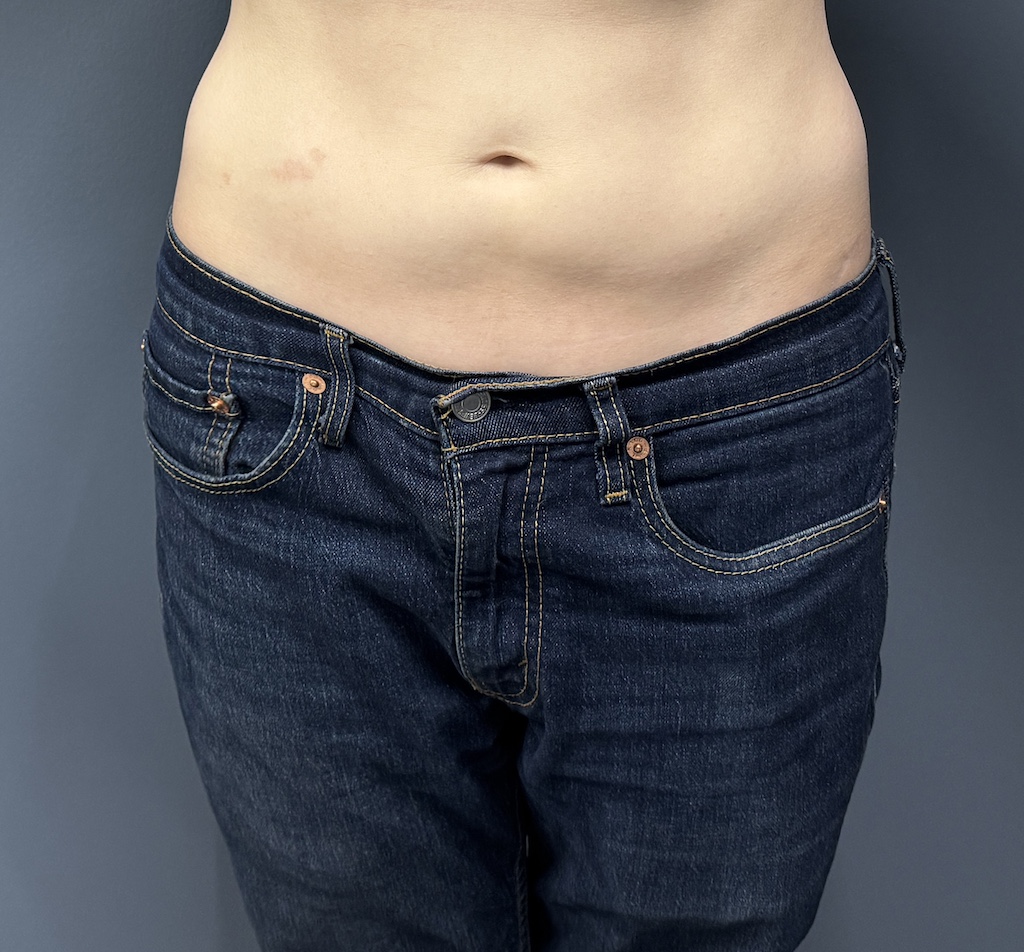 Pelvic Plasty for Female Body Contouring: Case Study and Long Term ...