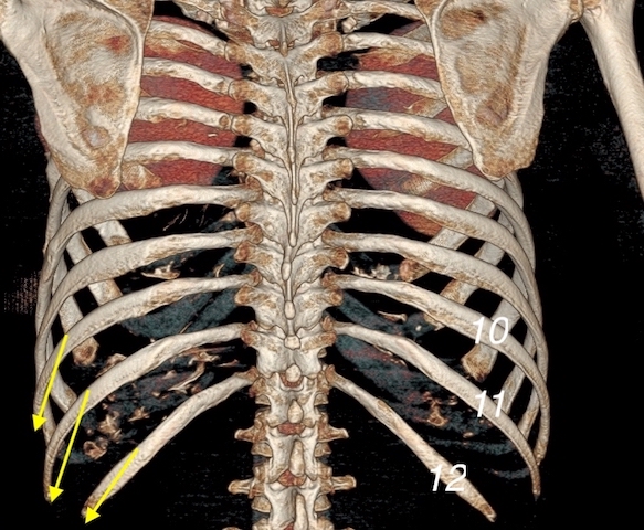 Rib 11–12 (Type 1) vs Rib 10–12 (Type 2) Resection in Advanced Waist ...