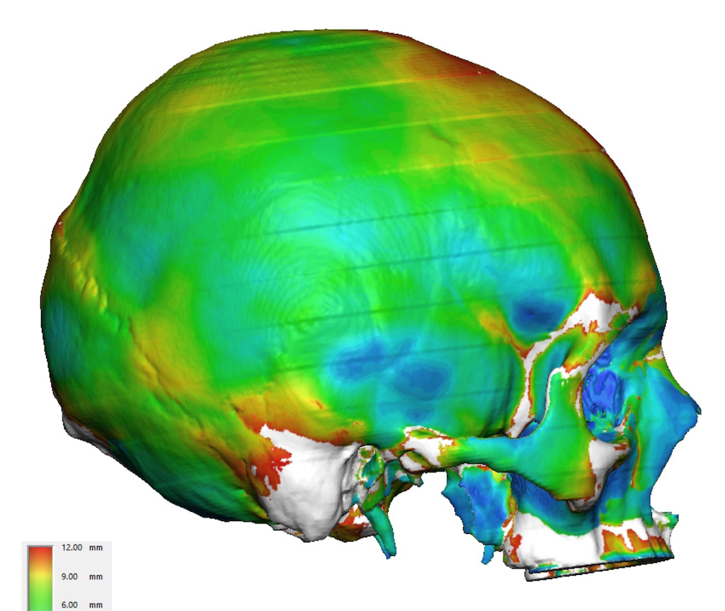 Skull Reduction Bone Thickness Color Mapping - Explore Plastic Surgery