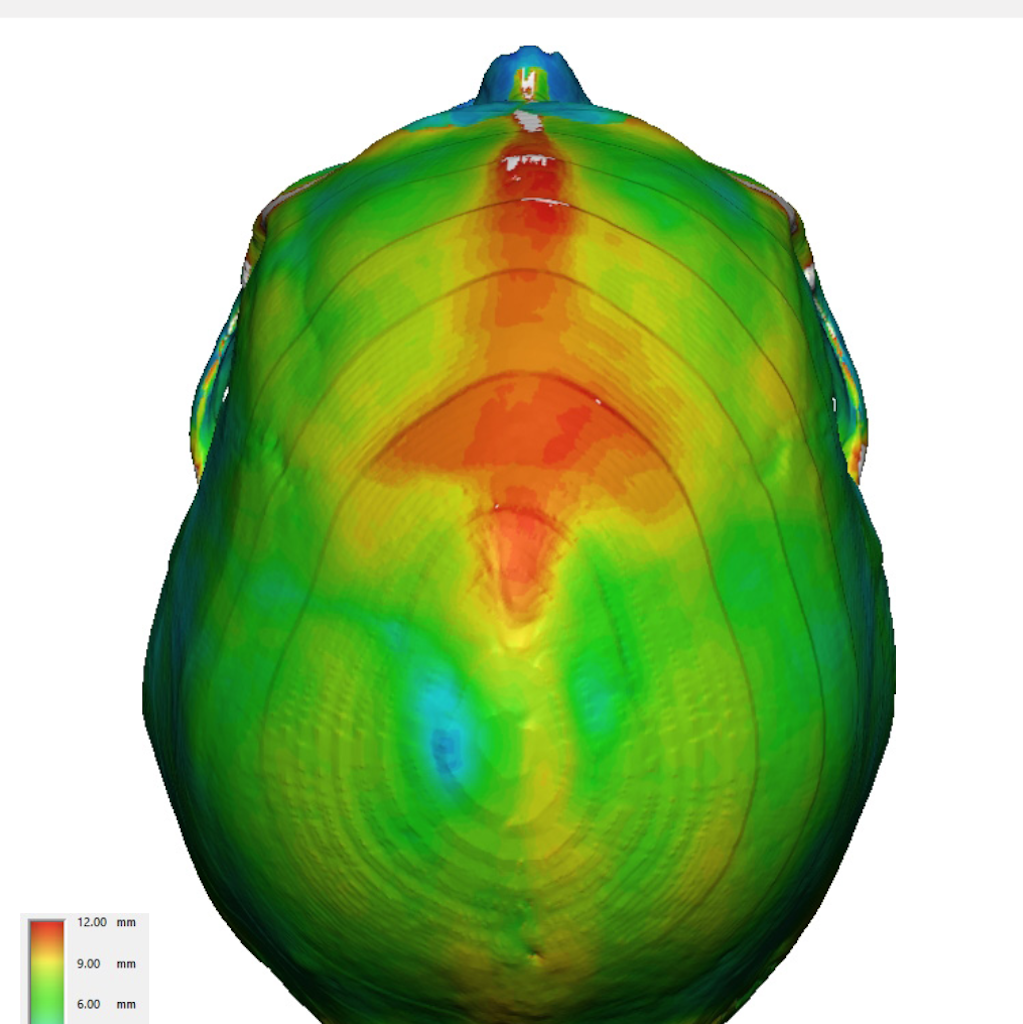 Skull Reduction Bone Thickness Color Mapping - Explore Plastic Surgery