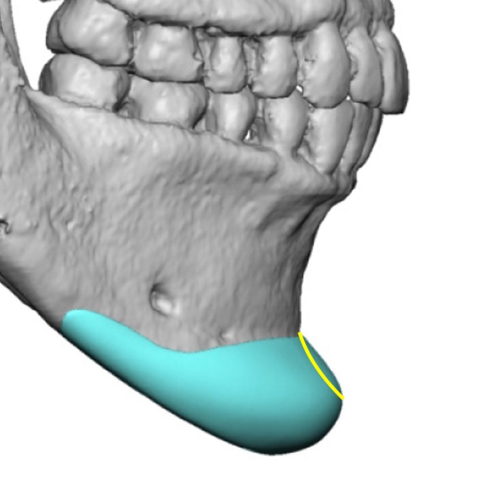 Custom Chin Implant Design Strategies To Minimize Labiomental Fold ...