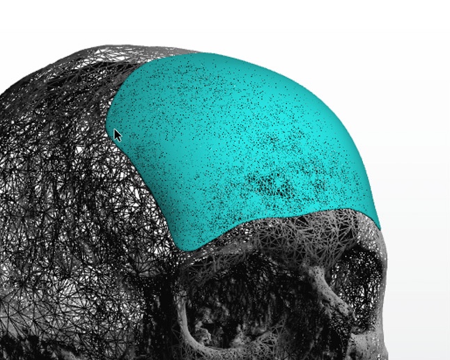 Forehead Augmentation: Comparative Analysis of Bone Cement and Custom ...