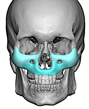Custom Midface Mask Implants and LeFort Midface Osteotomies ...