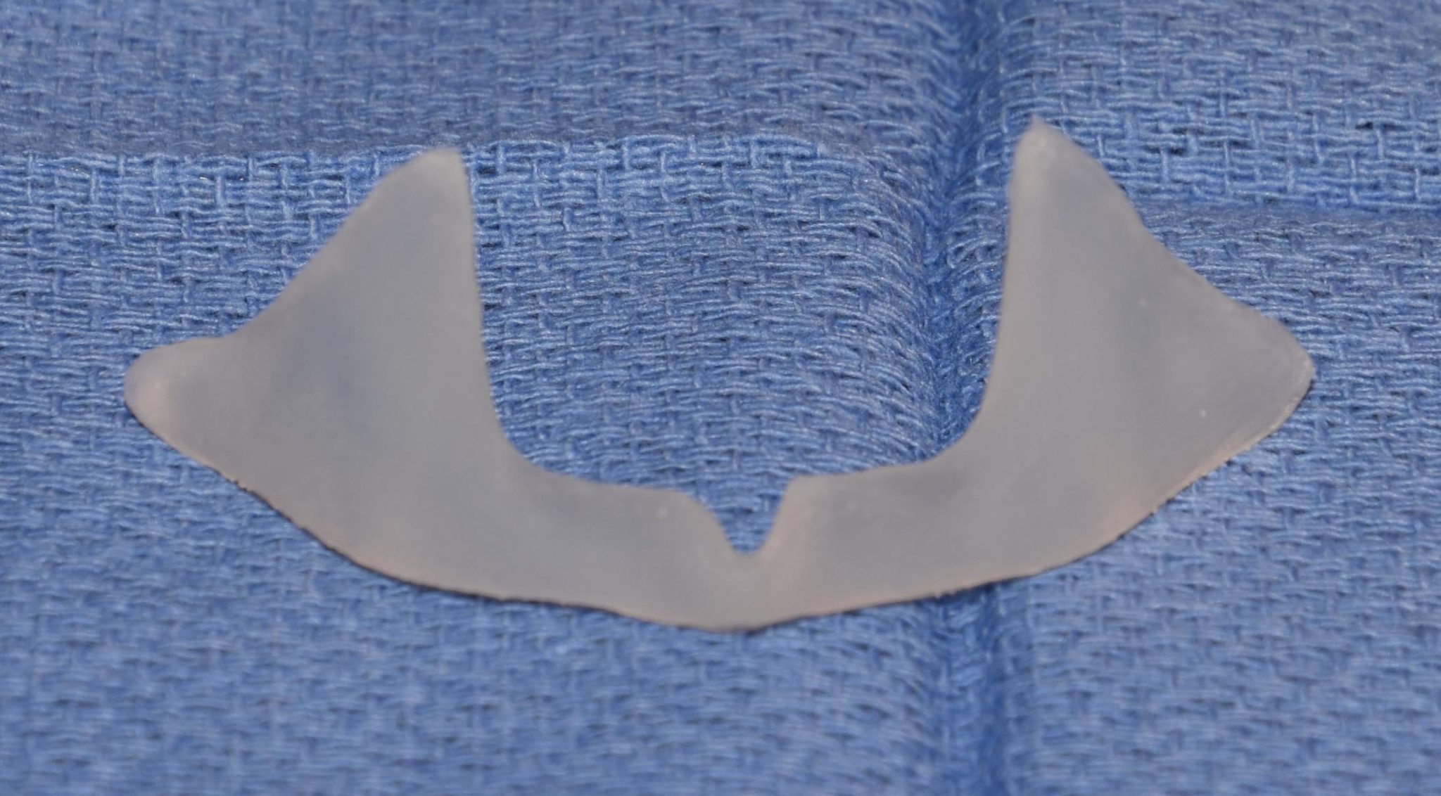 Custom Midface Implants vs Off-The-Shelf (Standard) Midface Implants ...