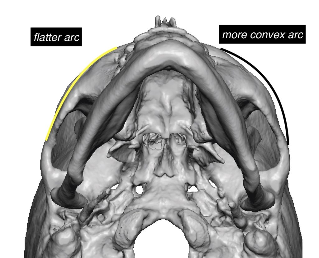 Custom Cheek Implants and Zygmatic Arch Augmentation - Explore Plastic ...