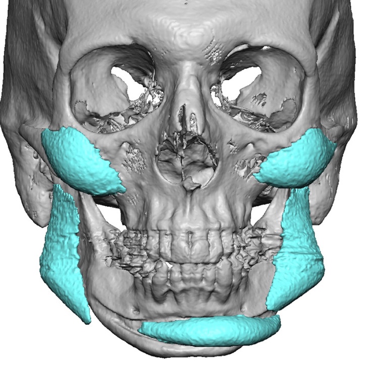 Aesthetic Jaw Augmentation - Comparing Standard vs Custom Implants ...