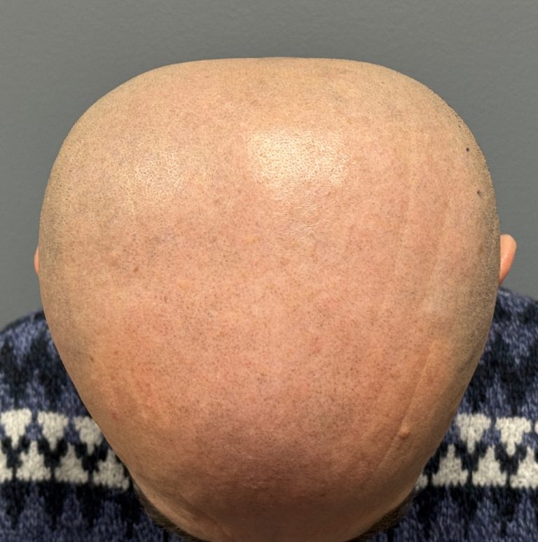 Adult Brachycephaly Skull Reshaping Case Study - Explore Plastic Surgery