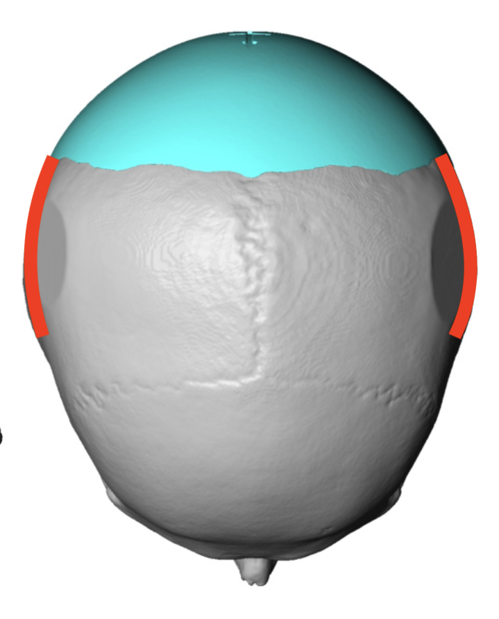 Adult Brachycephaly Skull Reshaping Case Study - Explore Plastic Surgery