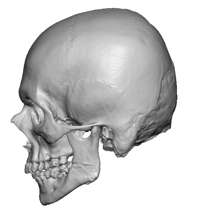 Adult Brachycephaly Skull Reshaping Case Study - Explore Plastic Surgery