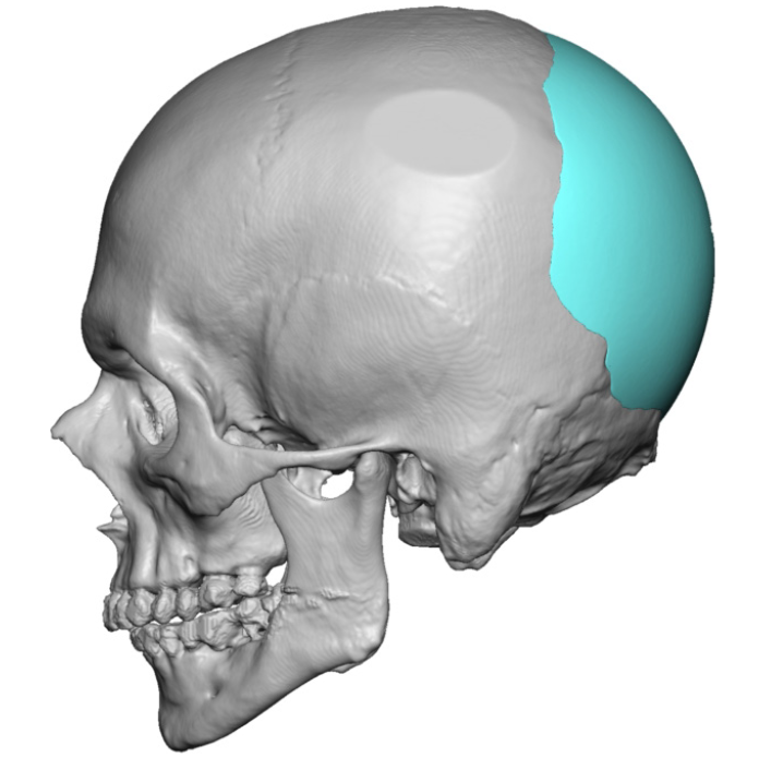 Adult Brachycephaly Skull Reshaping Case Study - Explore Plastic Surgery