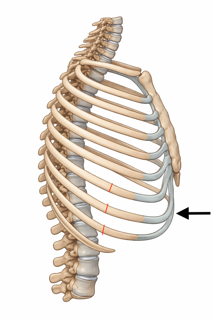 Ribcage Reshaping Osteotomies for Subcostal Rib Flare - Explore Plastic ...