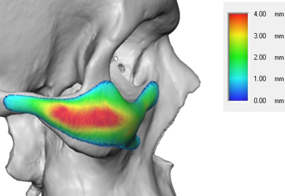 Ciustom Infraorbital-Malar Implants in Negative Orbital Vector Anatomy ...
