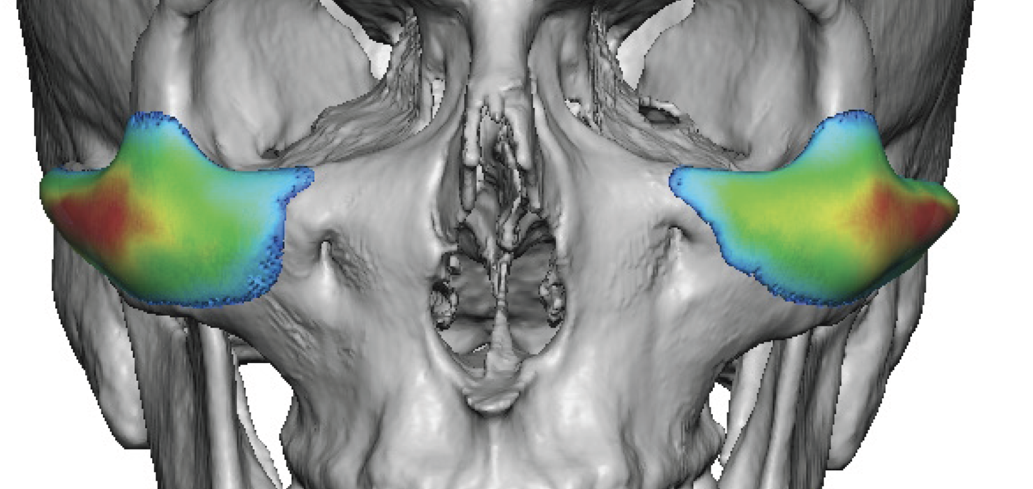 Isolated Zygomatic Arch Implants: Anatomical Considerations, Aesthetic ...