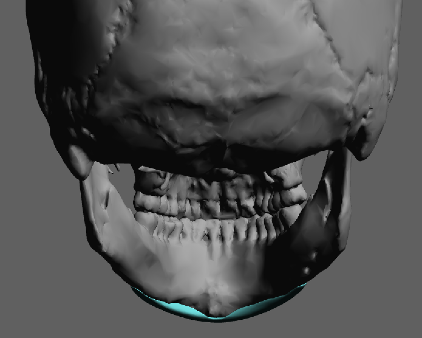 Custom Chin Implant for Mini V Line Surgery Reversal - Case Study ...