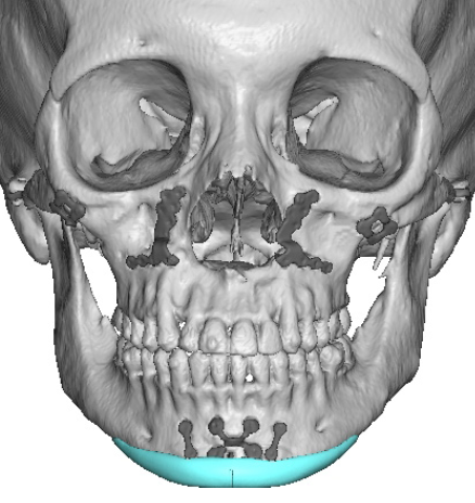 Custom Chin Implant for Mini V Line Surgery Reversal - Case Study ...