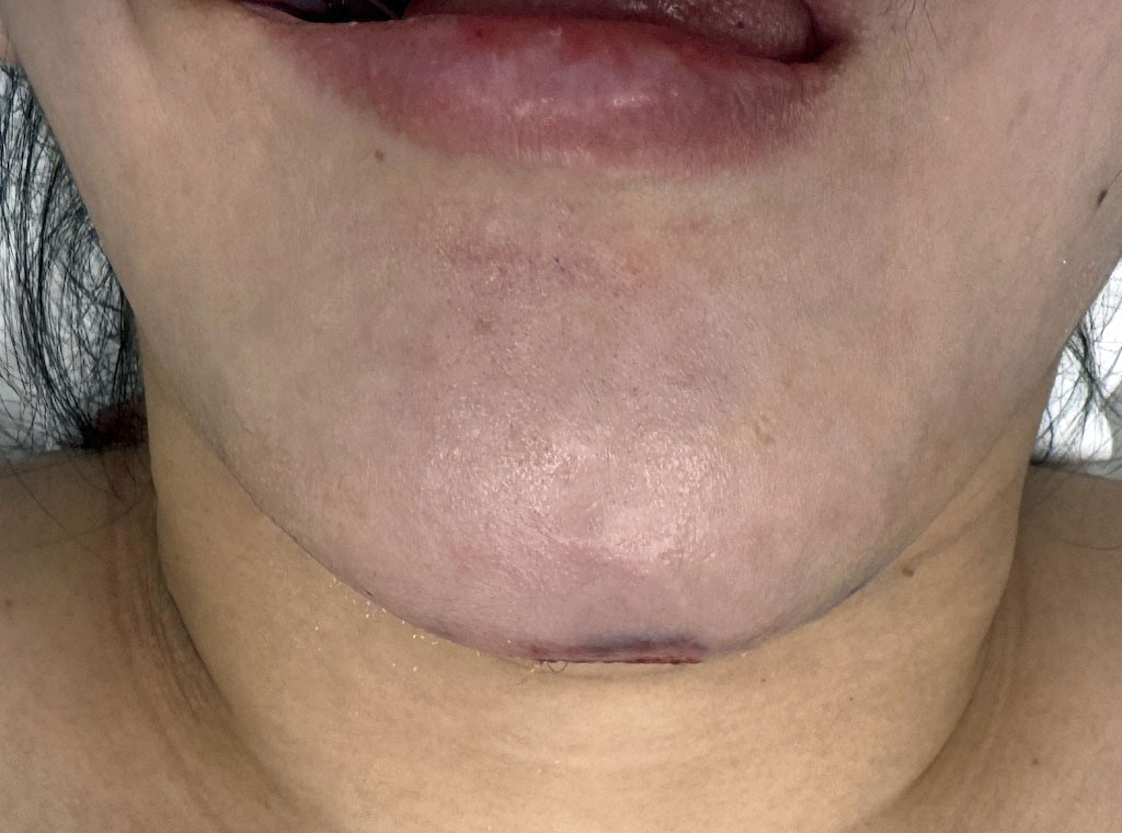 Custom Chin Implant for Mini V Line Surgery Reversal - Case Study ...