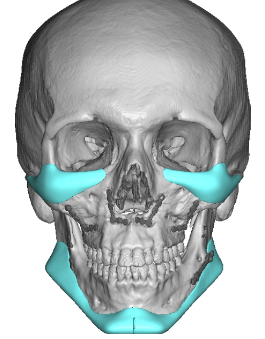 Custom Facial Implants After Double Jaw Surgery (Bimaxillary Osteotomy ...