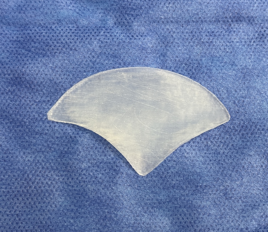 Custom Male Glabellar Forehead Implant for Correction of Pseudo Brow ...