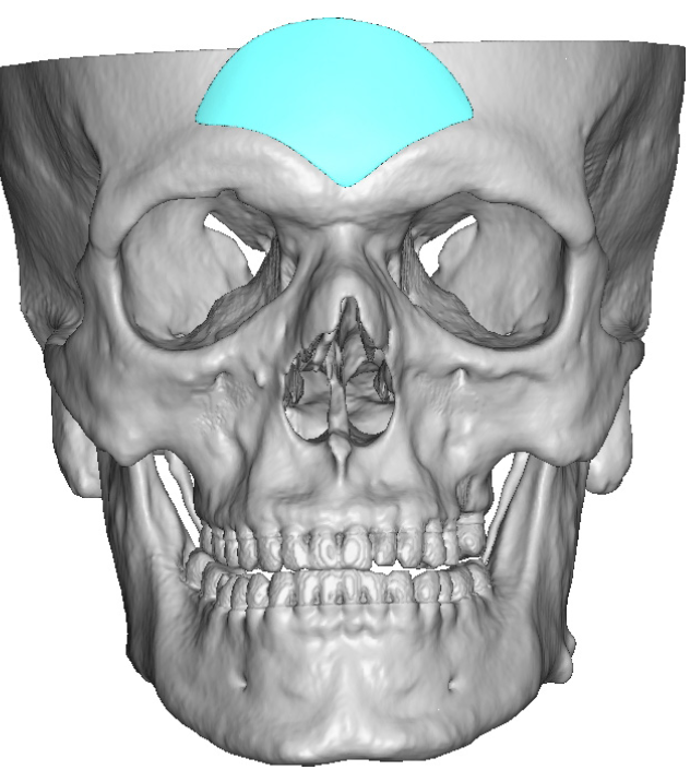 Custom Male Glabellar Forehead Implant for Correction of Pseudo Brow ...