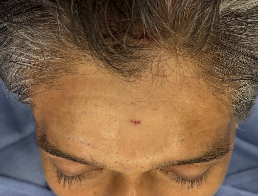 Custom Male Glabellar Forehead Implant for Correction of Pseudo Brow ...