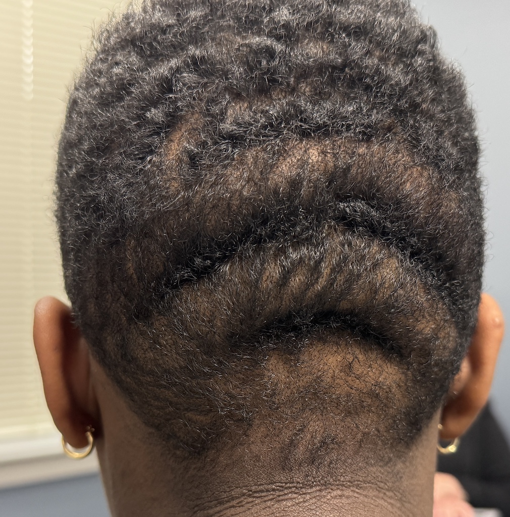 Double Occipital Scalp Roll Excision Case Study - Explore Plastic Surgery