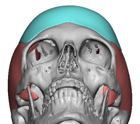 Female Forehead Implant Augmentation Concepts - Explore Plastic Surgery