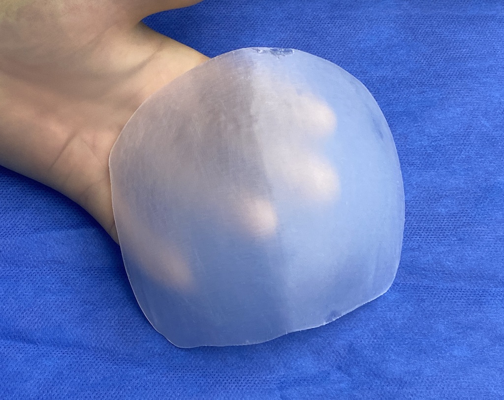 Female Forehead Implant Augmentation Concepts - Explore Plastic Surgery